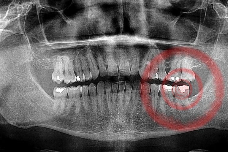 How an Infected Tooth Leads to Bone Loss - Perry Endodontics
